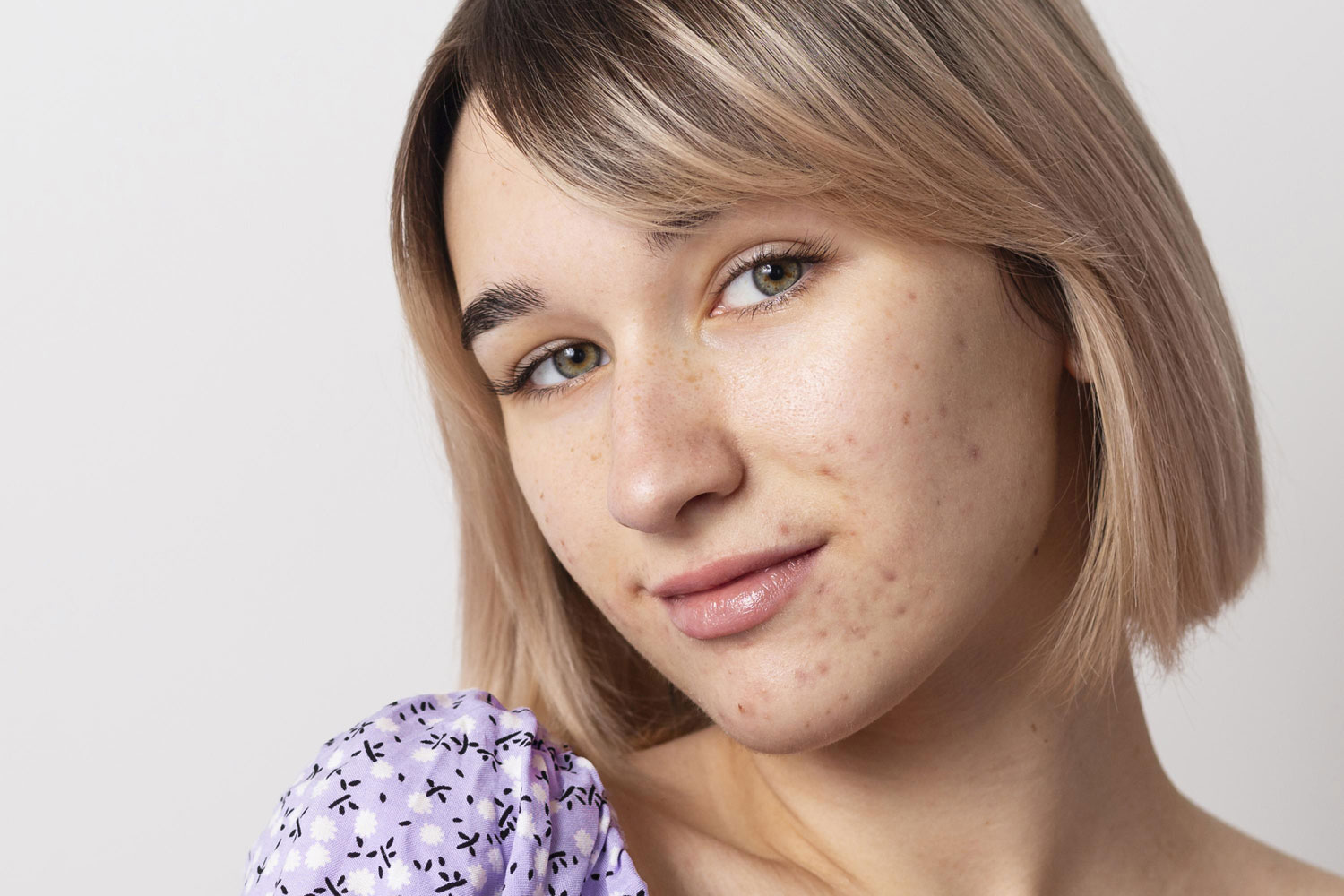 Acne vulgaris: le cause e i trattamenti